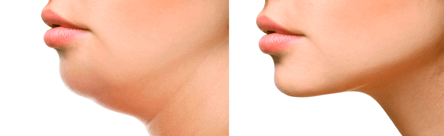 Lipoescultura de Papada - Eslait Cirugía Plástica